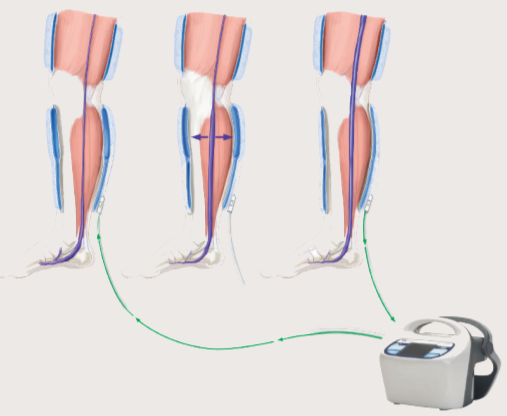 Buy Kendall SCD 700 Controller [Smart Compression Therapy]