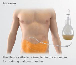 Buy Denver Pleurx Drainage Kit by Carefusion [FSA Approved]