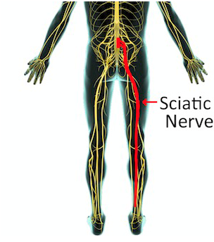 Sciatic Nerve Pain: Causes and Treatments | HPFY