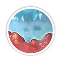 Buy Aquacel Ag Extra Hydrofiber Dressing | Wound Dressing