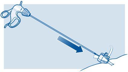 Buy Surgicel Original Absorbable Hemostat [FSA Approved]
